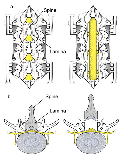 Lumbar Discectomy/Laminectomy - Parkside Hospital
